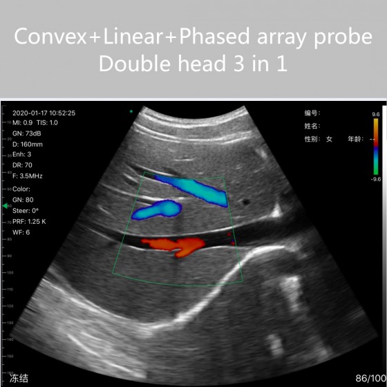 TG0439 192 Elements Wireless Color Doppler Ultrasound Convex＋Linear ...